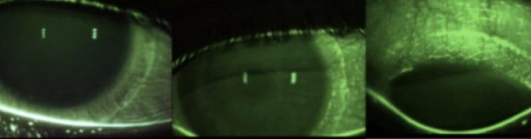 Why Do Opticians Put Dye In Your Eye Why Do Opticians Put Dye In Your Eye