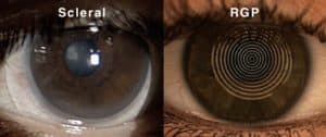 Scleral Lenses vs. RGP Lenses – When To Choose Which?